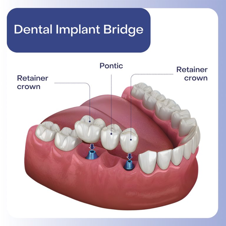 Dental Bridges Hackensack, NJ | Implant Bridge Hackensack, New Jersey