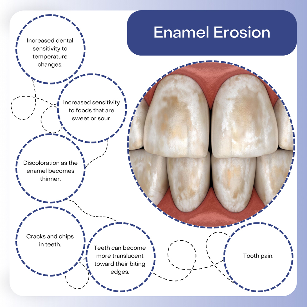 Enamel Erosion Treatment In Hackensack NJ My New Jersey Dentist Enamel Erosion Treatment In Hackensack NJ My New Jersey Dentist