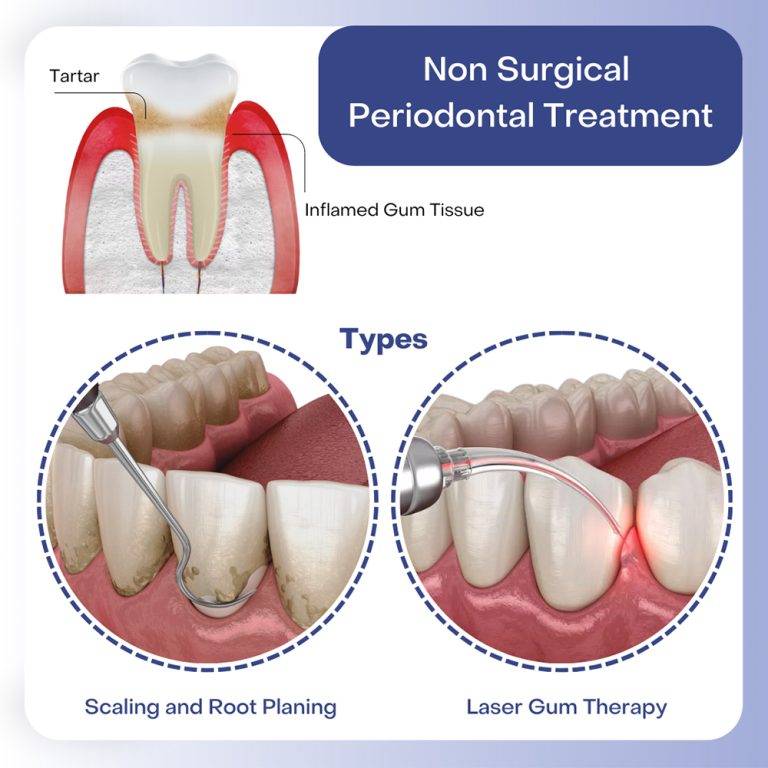Non-Surgical Periodontal Treatments in Hackensack, NJ