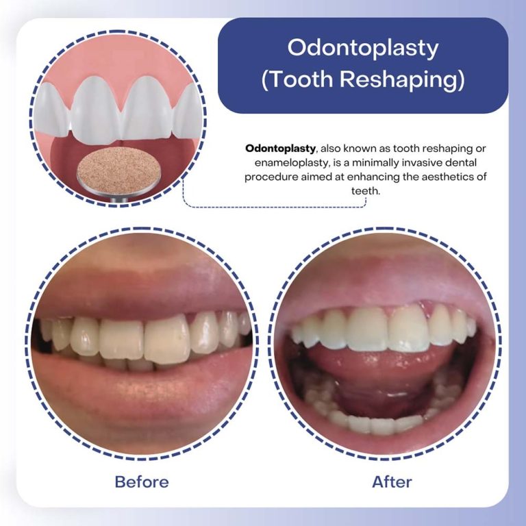 Tooth Reshaping Hackensack, NJ | Odontoplasty in New Jersey