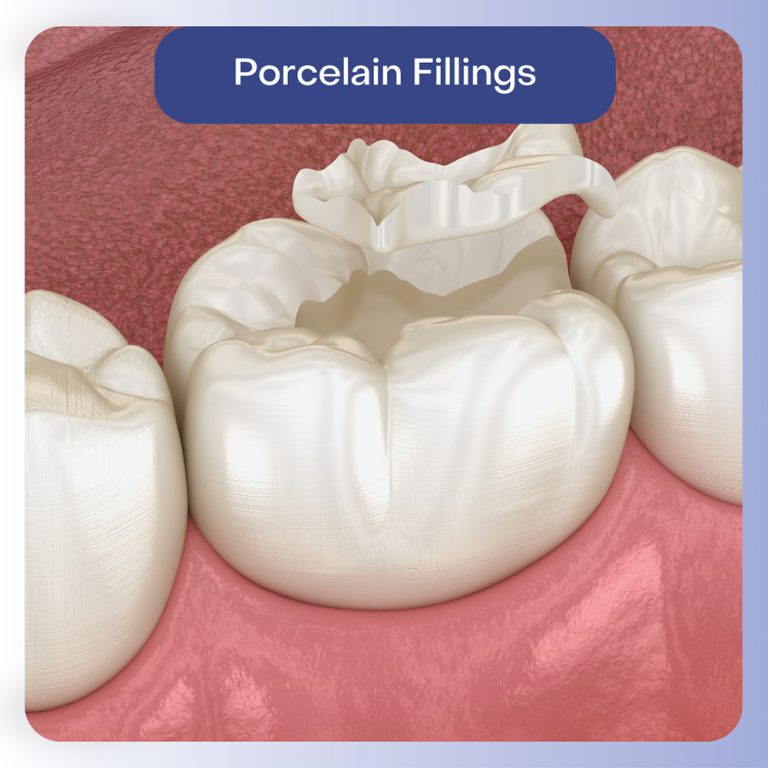 Porcelain & Composite Dental Fillings in Hackensack, Bergen County, NJ