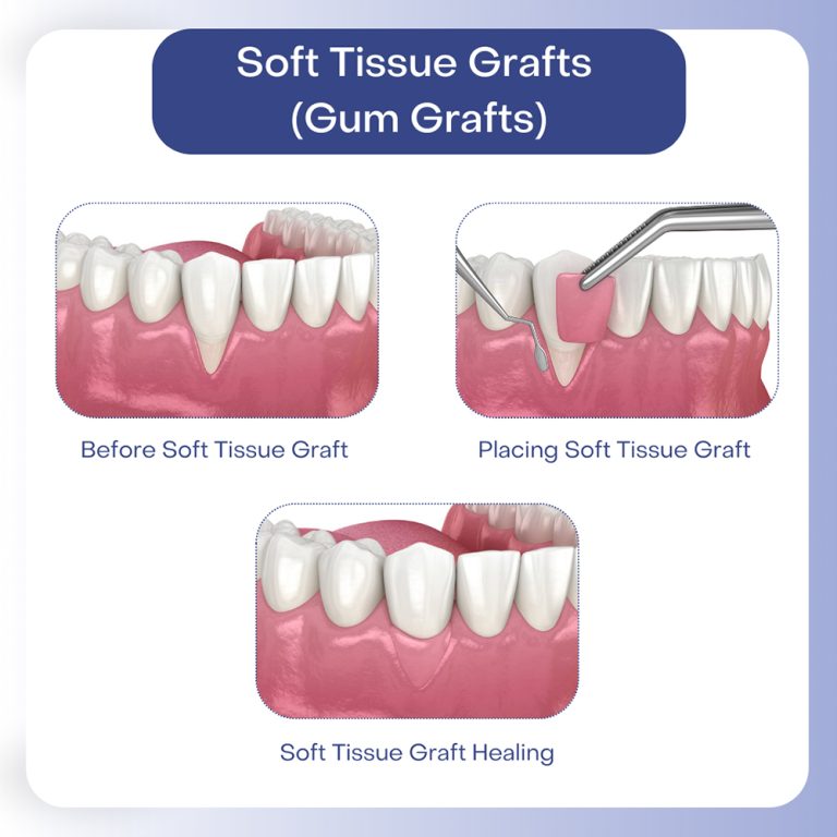Gum Grafting Hackensack, NJ | Soft Tissue Grafting NJ