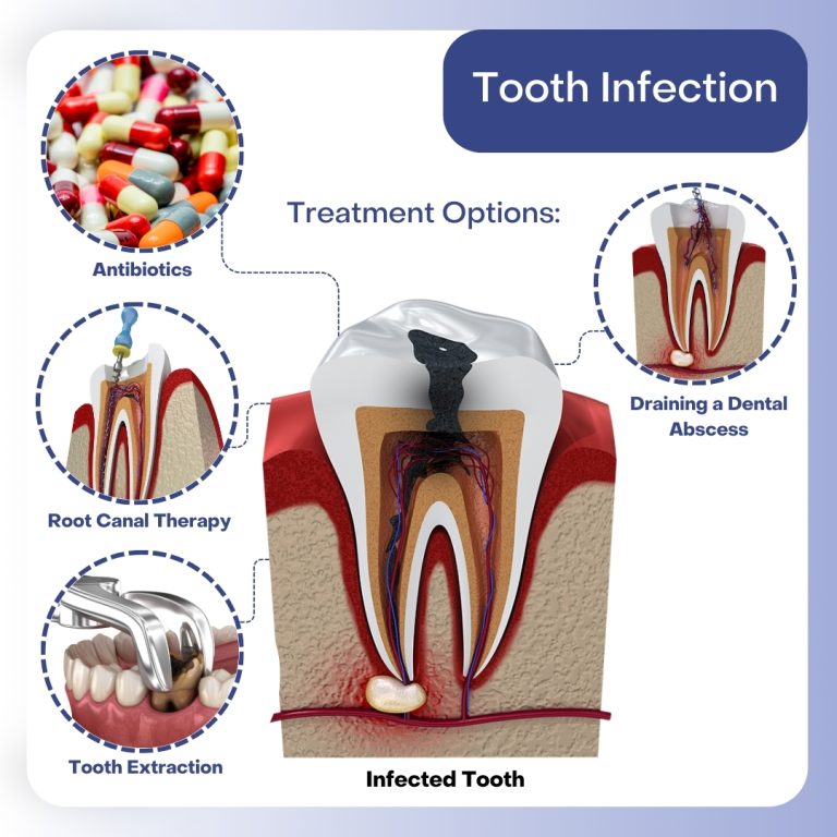 Tooth Infection Treatment Hackensack | Wisdom Tooth & Root Canal Infection